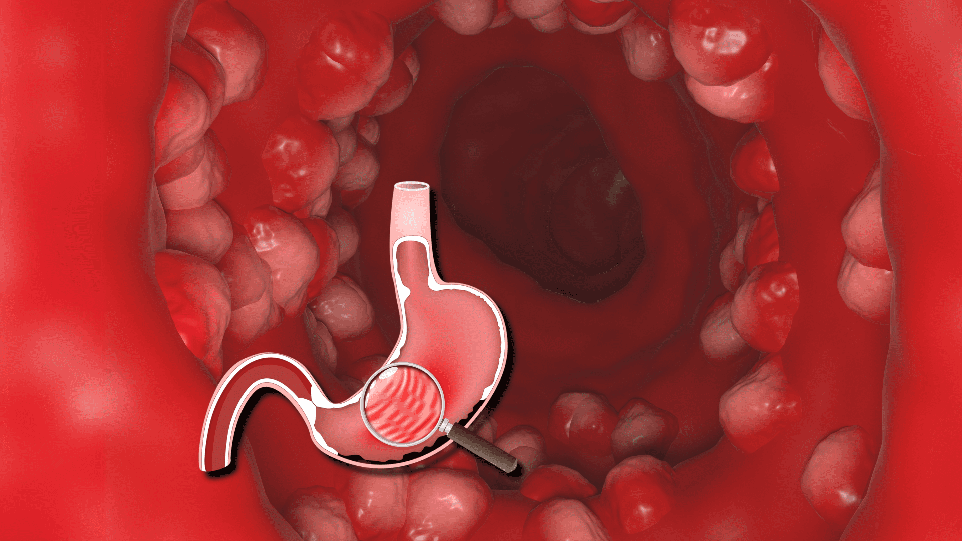 Living with Autoimmune Gastritis: What You Need to Know